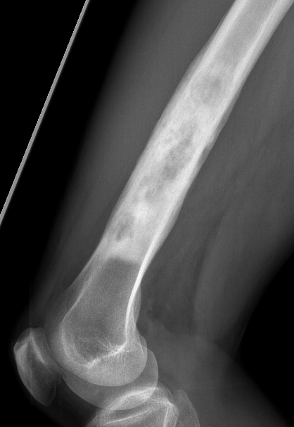 Conventional Osteosarcoma | The Bone School